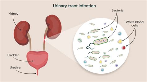 Urinary Tract Infection