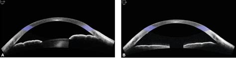 Figure From Angle Closure Glaucoma In A Myopic Patient Precipitated By Sexual Excitation A