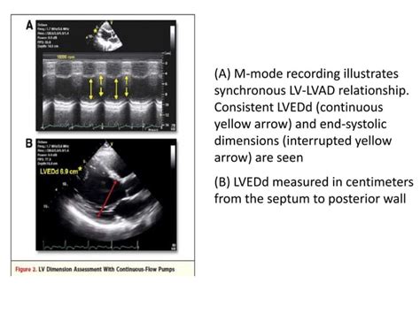 Lvad Left Ventricular Assist Device Echo Pptx