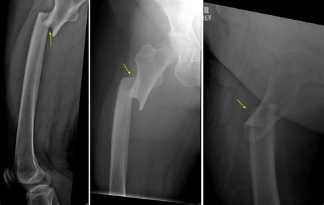 Femoral Insufficiency Fracture Related To Bisphosphonate Use Semantic Scholar