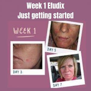 Best Efudix For Sun Spots Treatment In Brisbane Dr Davin Lim