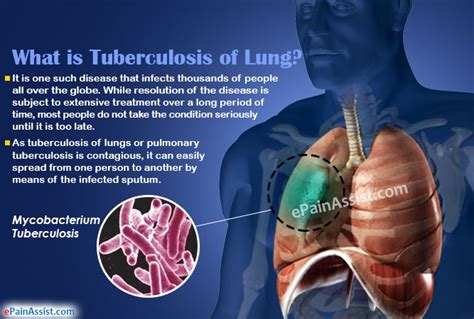 Tuberculosis Of Lung Or Pulmonary Tuberculosis Causes Symptoms Types Treatment Pathophysiology