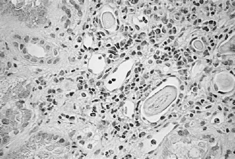 Light Microscopic Findings In A Renal Interstitial Eosinophilia