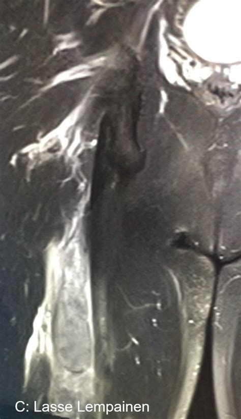 Hamstring Injury Information Urheiluortopedi Lasse Lempainen