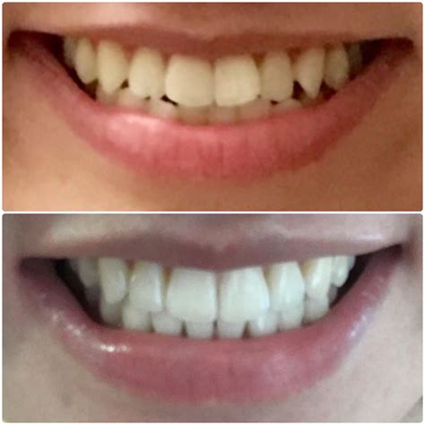 93 Best Ipr Images On Pholder Invisalign Braces And Ford Diesels