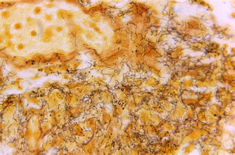 Syphilis Cases Highest Since 1948 Hiv Jumped 16 Last Year Cdc Says