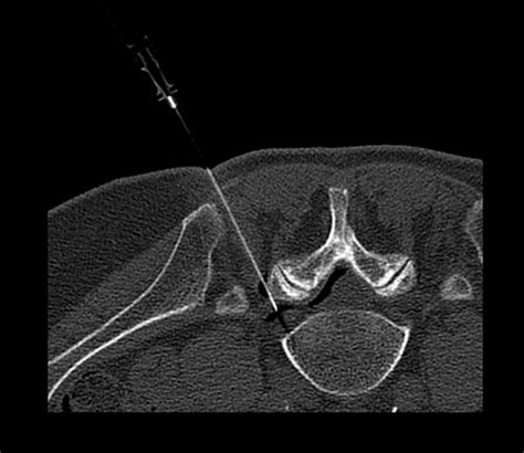 Transforaminal Nerve Root Block Pacs