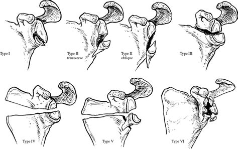 Scapula Fractures Musculoskeletal Key