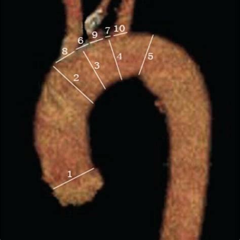 Multidetector Computed Tomography Angiography Showed The Proximal Download Scientific Diagram