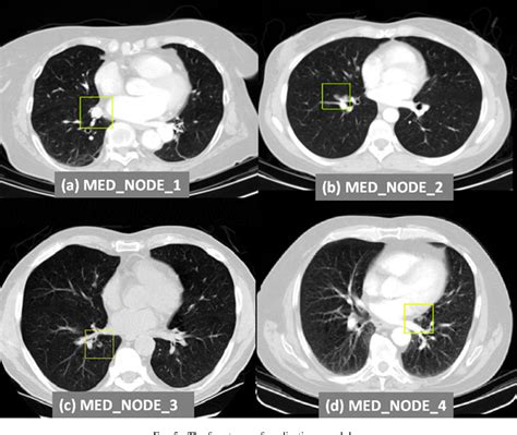Figure 6 From Hybrid Detection Of Lung Nodules On Ct Scan Images