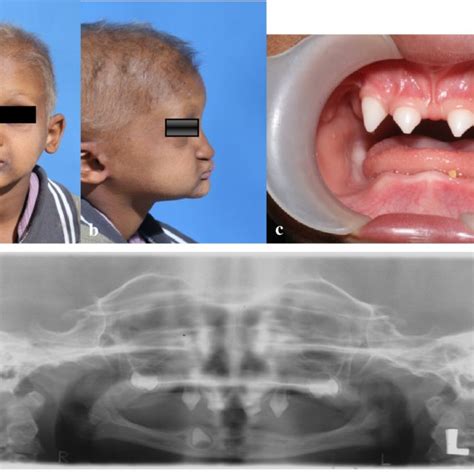 Ectodermal Dysplasia