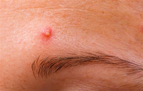 Pimple Rash On Chest