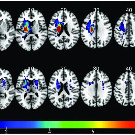 Lesion Overlap Maps Of A Acute Stroke Lesions And B Prior Stroke