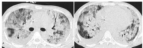 Diffuse Alveolar Hemorrhage In A 34 Year Old Patient With