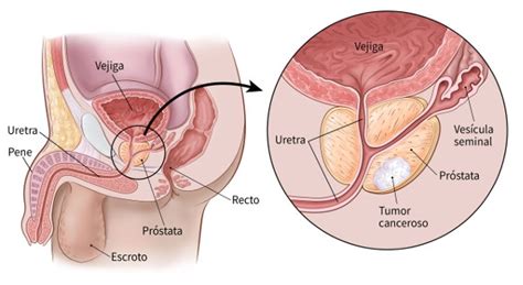 ¿qué Es El Cáncer De Próstata Tipos De Cáncer De Próstata American
