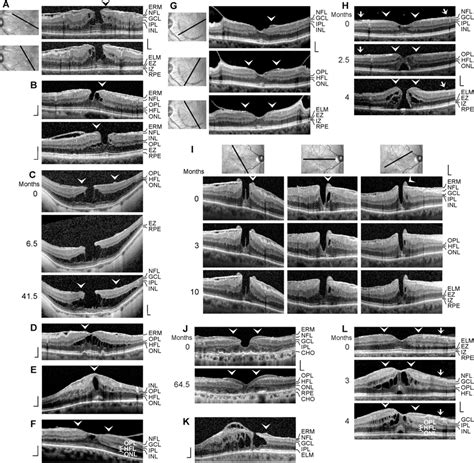 Lamellar Macular Hole Associated Epiretinal Proliferation Lhep In Download Scientific Diagram