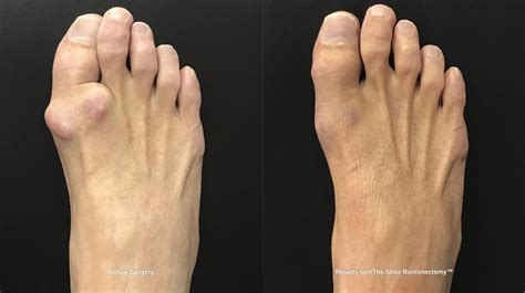 Hallux Rigidus Surgery Recovery