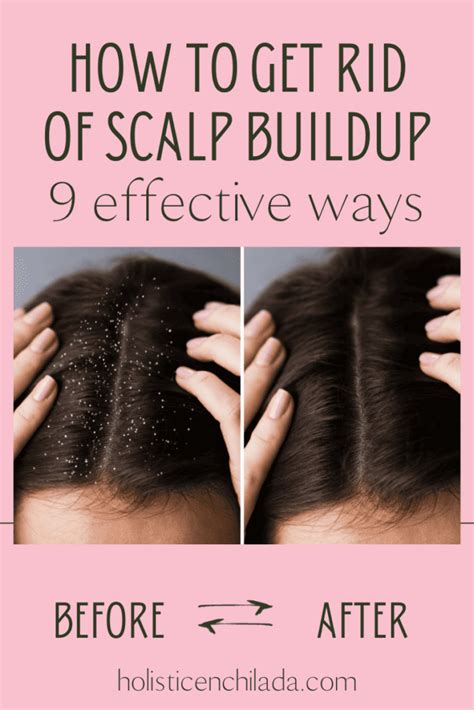 How To Get Rid Of Scalp Buildup 9 Effective Ways