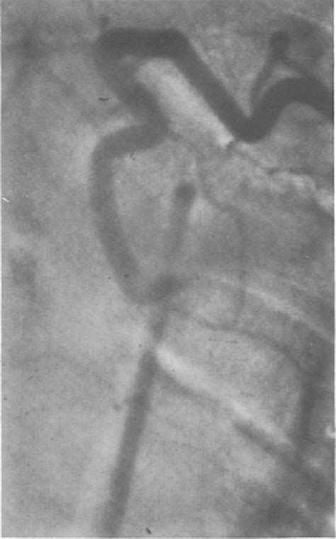 Figure 3 From Anterior Transthoracic Surgical Decompression Of Acute Spinal Cord Injuries