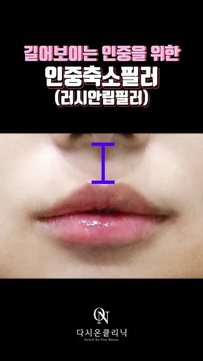 인중이 길어서 고민이에요ㅠㅠ입술필러로 완전해결 다시온의원 강남역피부과 강남역피부과 입술필러 입술필러잘하는곳 필러 인중축소 Youtube