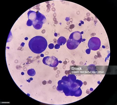 Malignant Fluid Cytology Cells Of Adenocarcinoma May Spread To Fluid Of