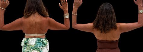 Brachioplasty 2 Inspire Aesthetics