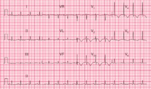ECG Case Marked Prolongation Of The QT Interval Long QT Syndrome Manual Of Medicine