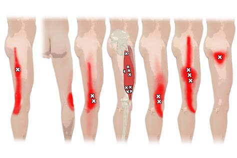 Vastus Intermedius Trigger Point