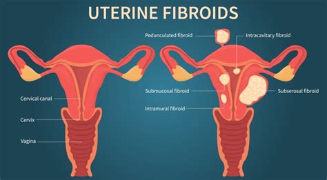 Outsmart Uterine Fibroids After Menopause Womans World
