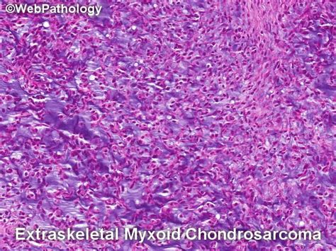 Myxoid Liposarcoma Differential