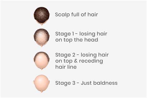 Male Pattern Baldness Androgenic Alopecia What Is It Causes