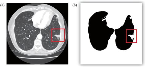 An Example Of The Missed Nodal Area A An Original Ct And B Download Scientific Diagram