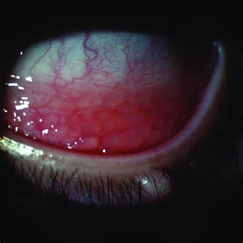 Follicular Conjunctivitis And Mc Lesion On The Eyelid Margin