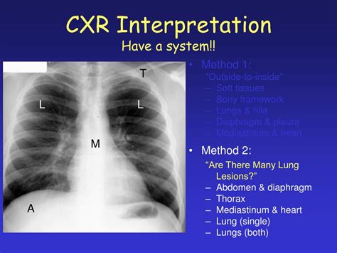 Ppt Introduction To Radiographic Interpretation Special Emphasis On Cxrs Powerpoint