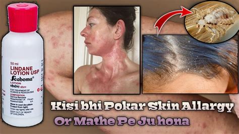 Scaboma Lotion Gamma Hexachloride 1 Side Effects Benefits Uses Digitalmedilife Youtube