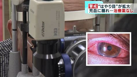 プレビュー警戒 都内で拡大流行性角結膜炎 充血や痛みに出血もはやり目TOKYO MX プラス