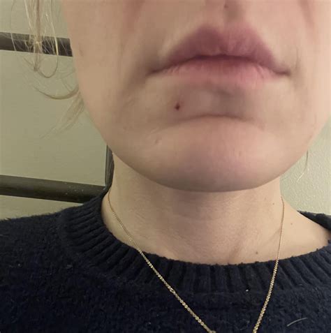 How Can I Treat This Post Pimple Scab Rskincareaddicts