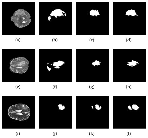 Brain Tumor Segmentation From Optimal Mri Slices Using A Lightweight U Net