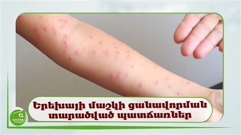 Երեխայի մաշկի ցանավորման տարածված պատճառներ Առողջնախագիծ Youtube