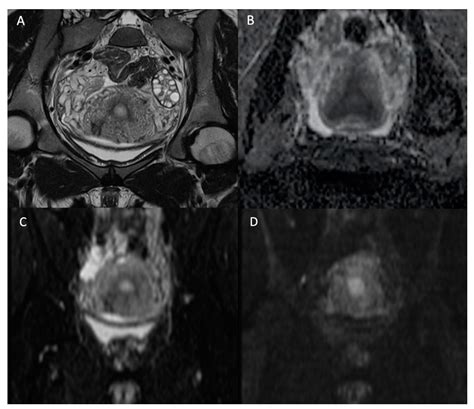 Diffusion Weighted Mri In The Genitourinary System