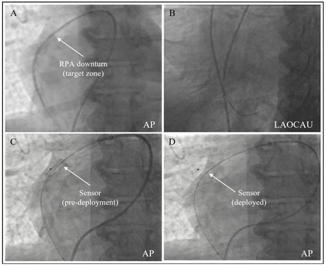 Guide For Implanting The Cordella Pulmonary Artery Pressure Sensor