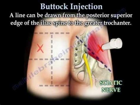 Intramuscular Injection Artofit