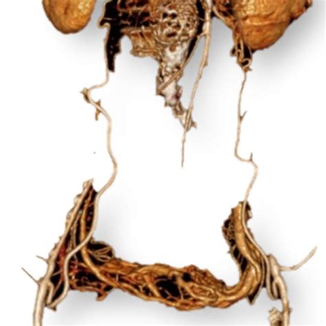 Three Dimensional Digital Subtraction Ct Angiography Demonstrating The