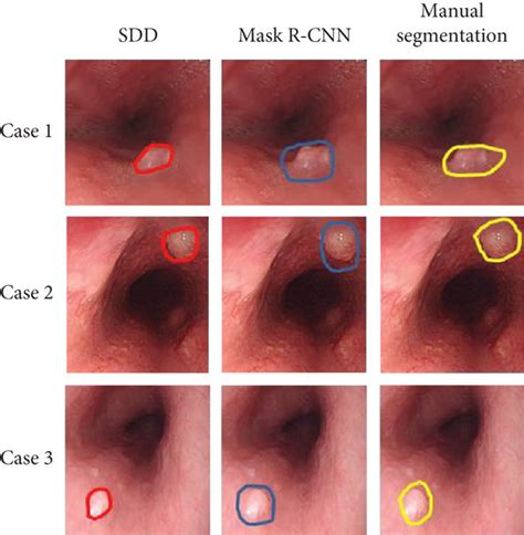Comparison Of The Effects Of Three Ways To Identify Polyps Download Scientific Diagram