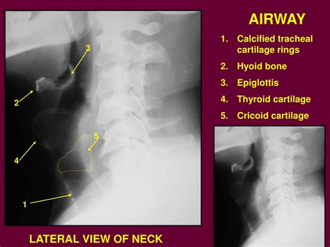 Thyroid Cartilage X Ray