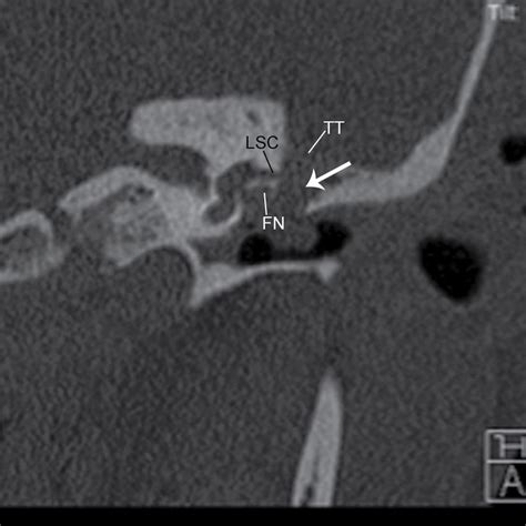 Scutum Temporal Bone