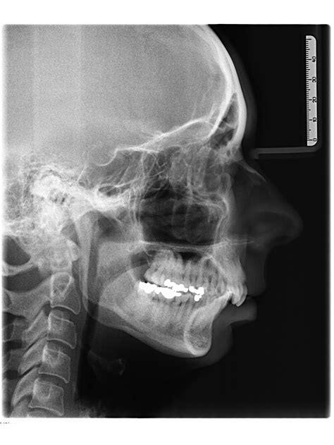 Divergence Classification Dataset And Pre Trained Model By Ortofe