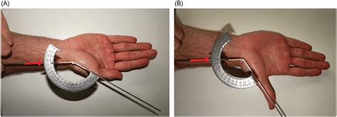 Radius Metacarpal Angle Was Measured With The Subjects Hand In A Radius Metacarpal Angle Was Measured With The Subjects Hand In A