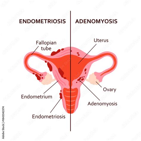 Endometriosis Vs Adenomyosis Comparison Diagram Split Uterus Vector