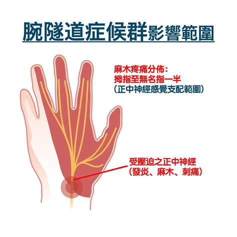 腕隧道症候群 手腕疾病專欄 手外科醫師